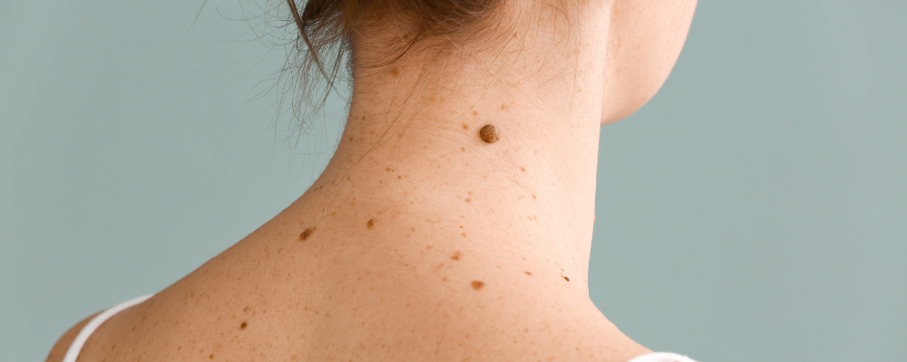 Skin Cancer Basics: Know Your ABCDEs - Arizona Dermatology